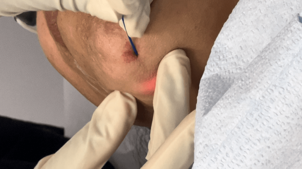 Laser EndoLifting – En Sante Clinic and Medical Spa